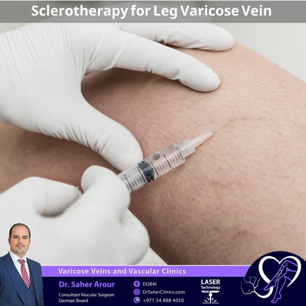 Sclerotherapy Varicose Vein Treatment - 7 Varicose Veins Clinics Dubai