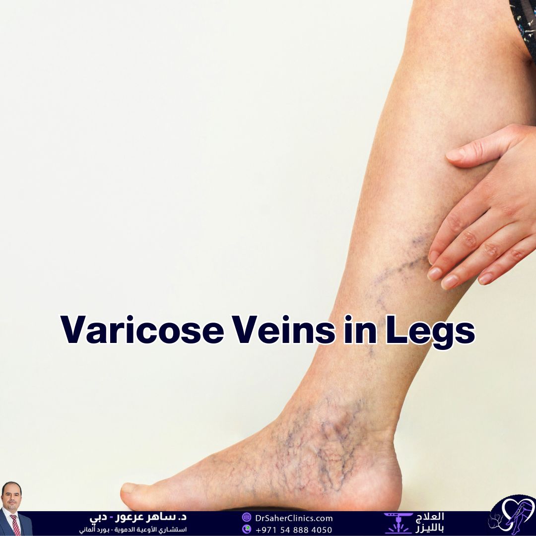 The Impact of Varicose Veins on Health