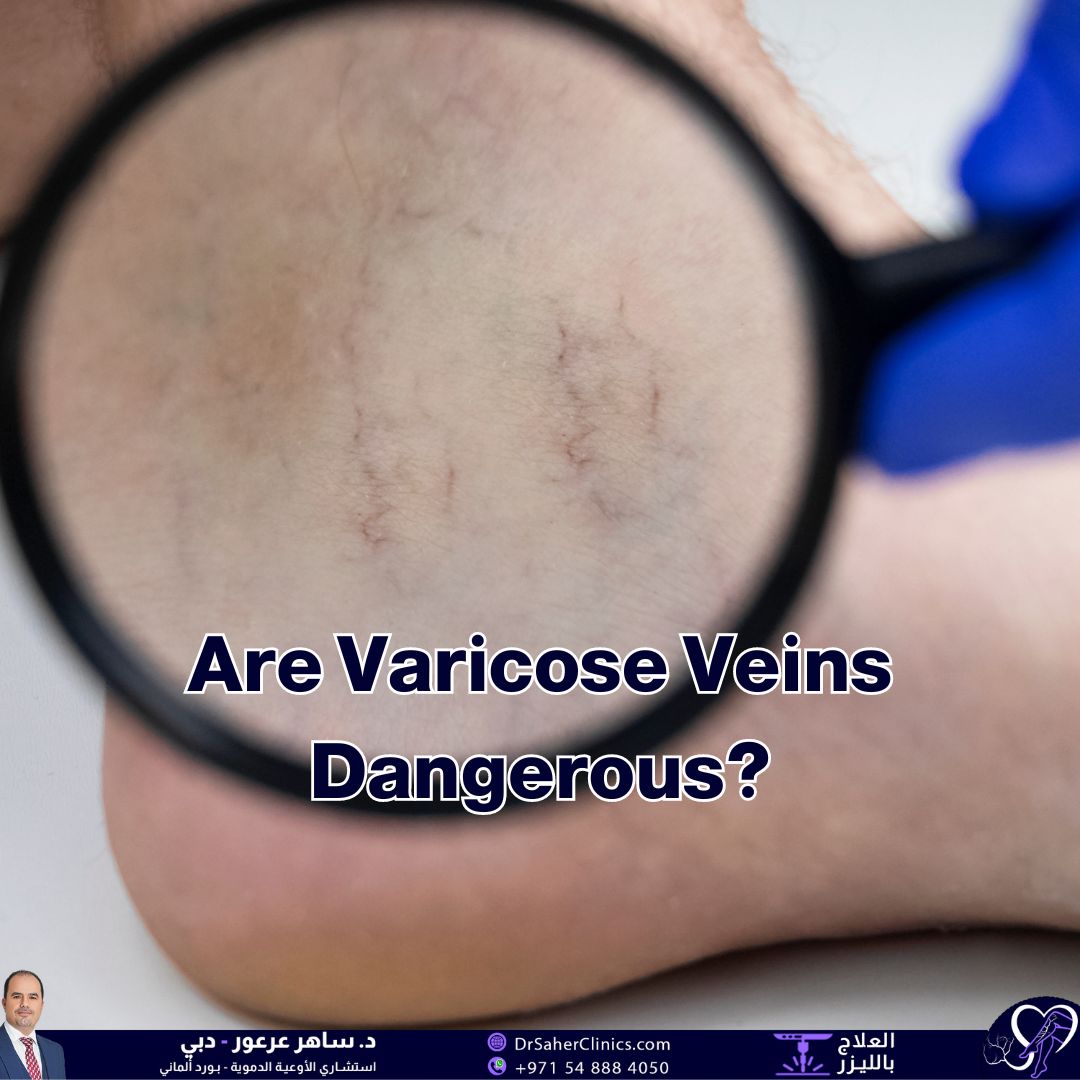 Are Varicose Veins Dangerous 